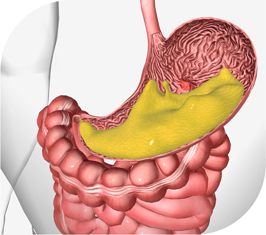 Diverticulitis, Colonic Diverticula Broward County, Florida