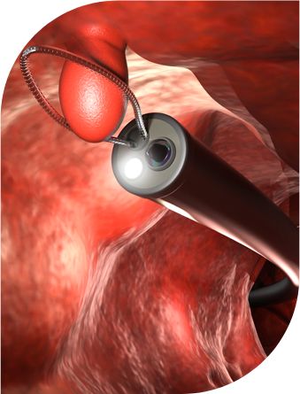 Colonoscopy Colonoscopies Procedure Guide